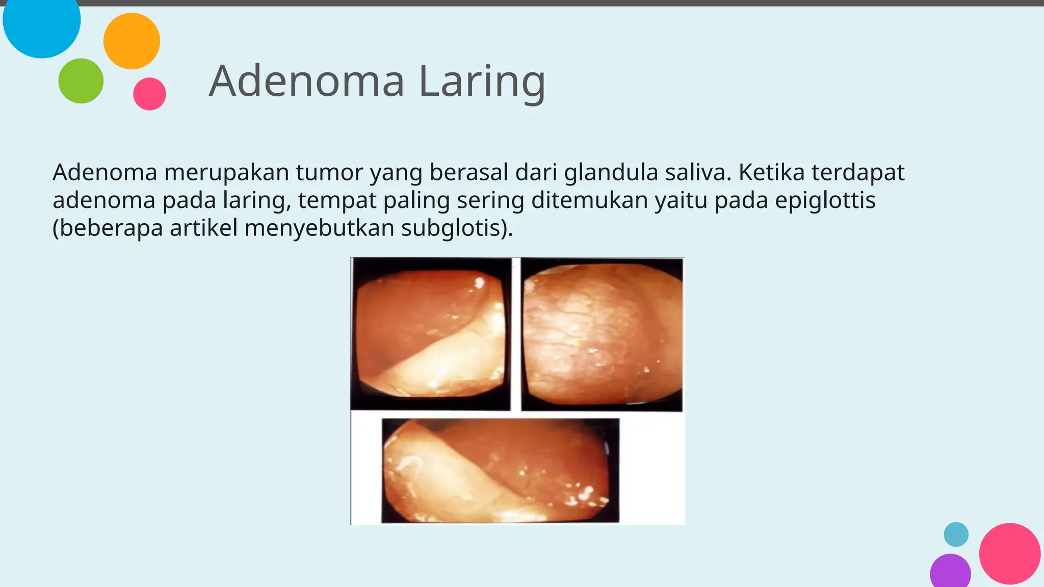 LAPORAN KASUS massa laring THT fix1.pptx