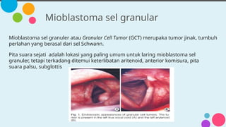 LAPORAN KASUS massa laring THT fix1.pptx