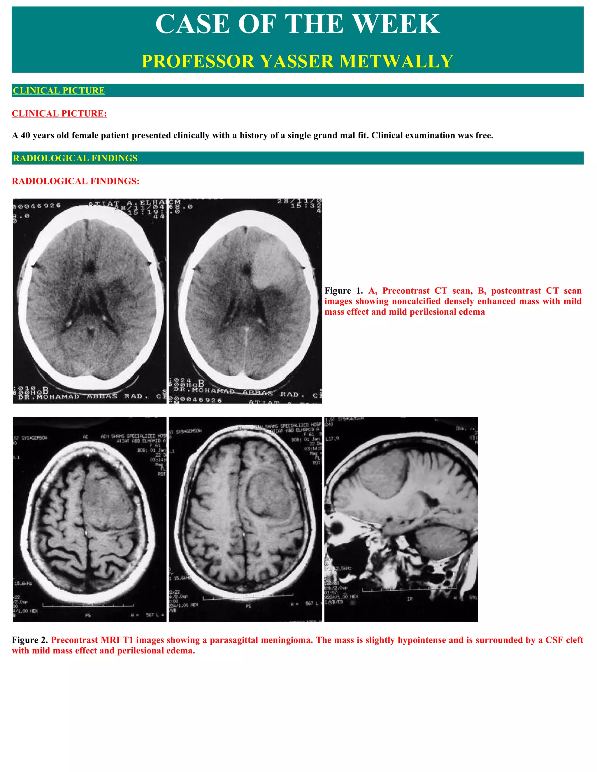 Case record...Parasagittal meningioma | PDF