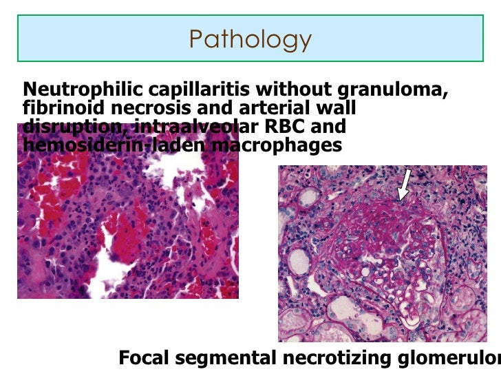 Microscopic Polyangiitis Histology