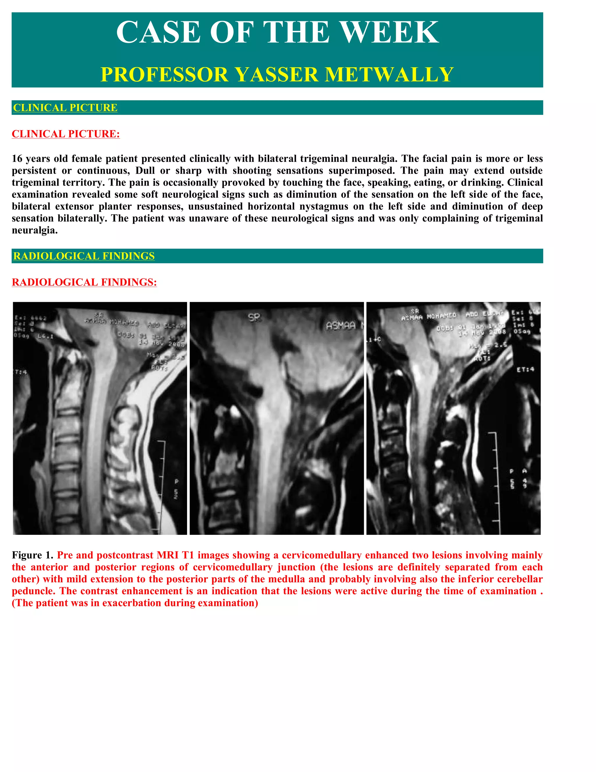 Case record..Multiple sclerosis presented clinically with bilateral ...