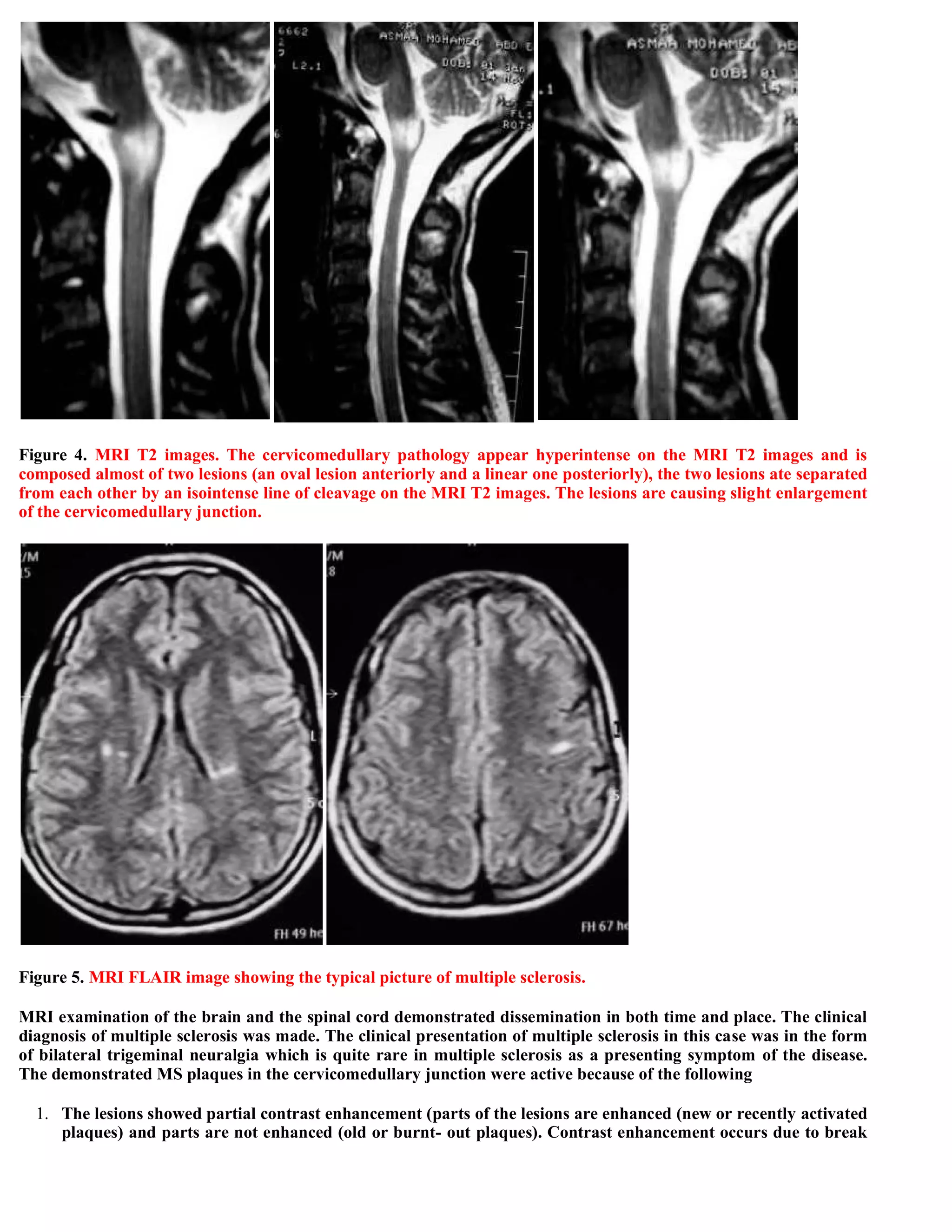 Case record..Multiple sclerosis presented clinically with bilateral ...