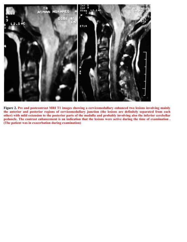 Case record..Multiple sclerosis presented clinically with bilateral ...