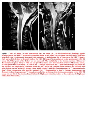 Case record..Multiple sclerosis presented clinically with bilateral ...