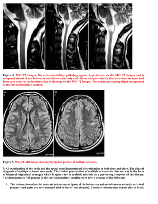 Case record..Multiple sclerosis presented clinically with bilateral trigeminal neuralgia and a ...