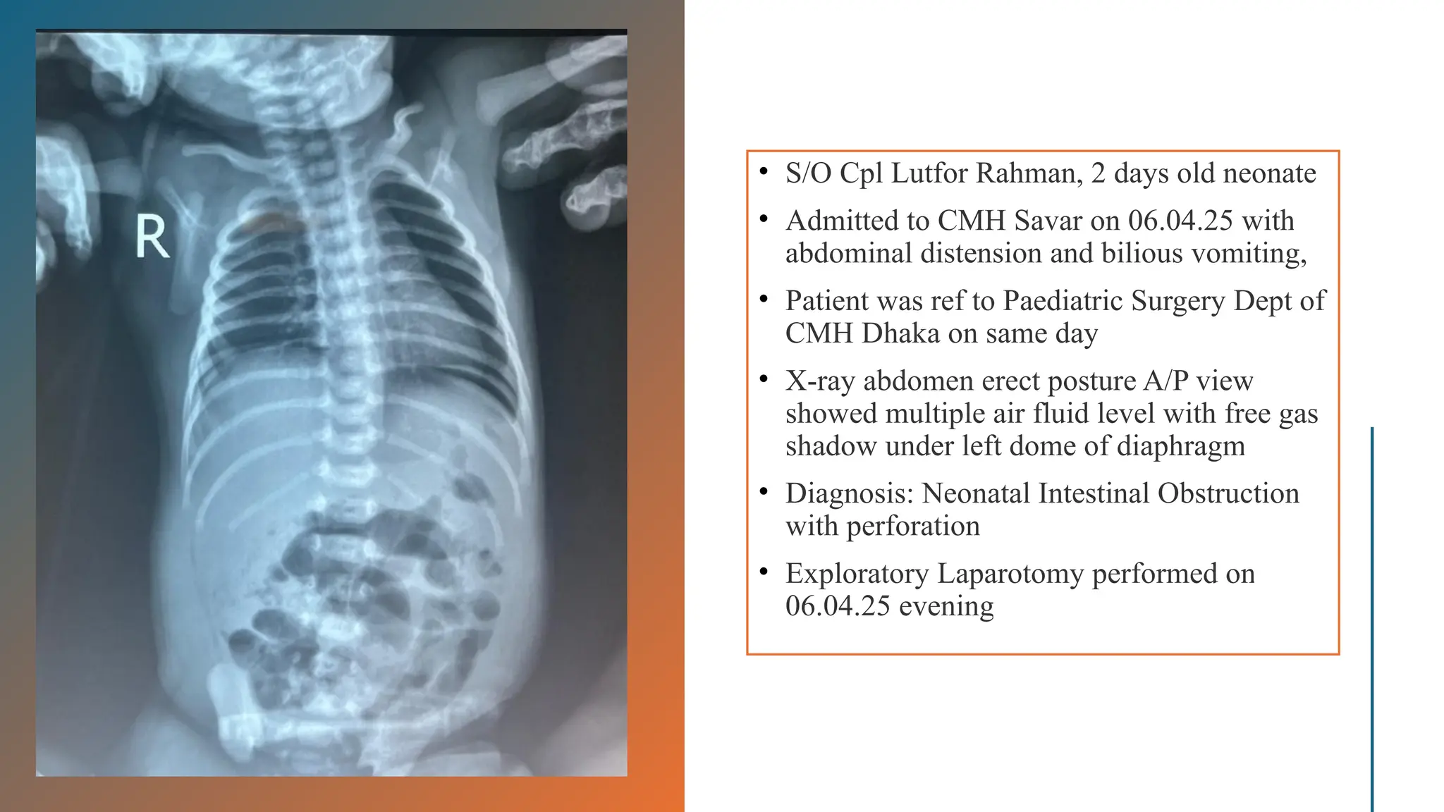 Neonatal Intestinal Obstruction in Paediatric Patient | PPTX