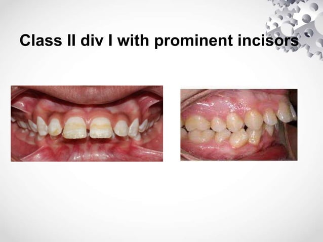 Case of avulsion in Permanent dentition.pptx