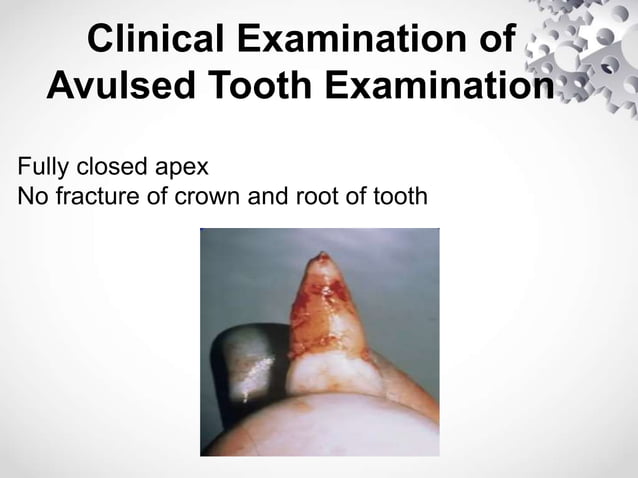 Case of avulsion in Permanent dentition.pptx