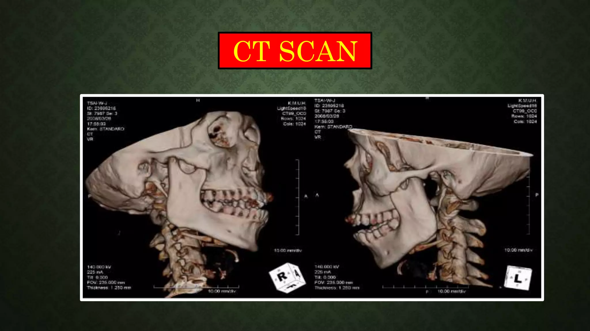 Case of bilateral tmj dislocation | PPTX