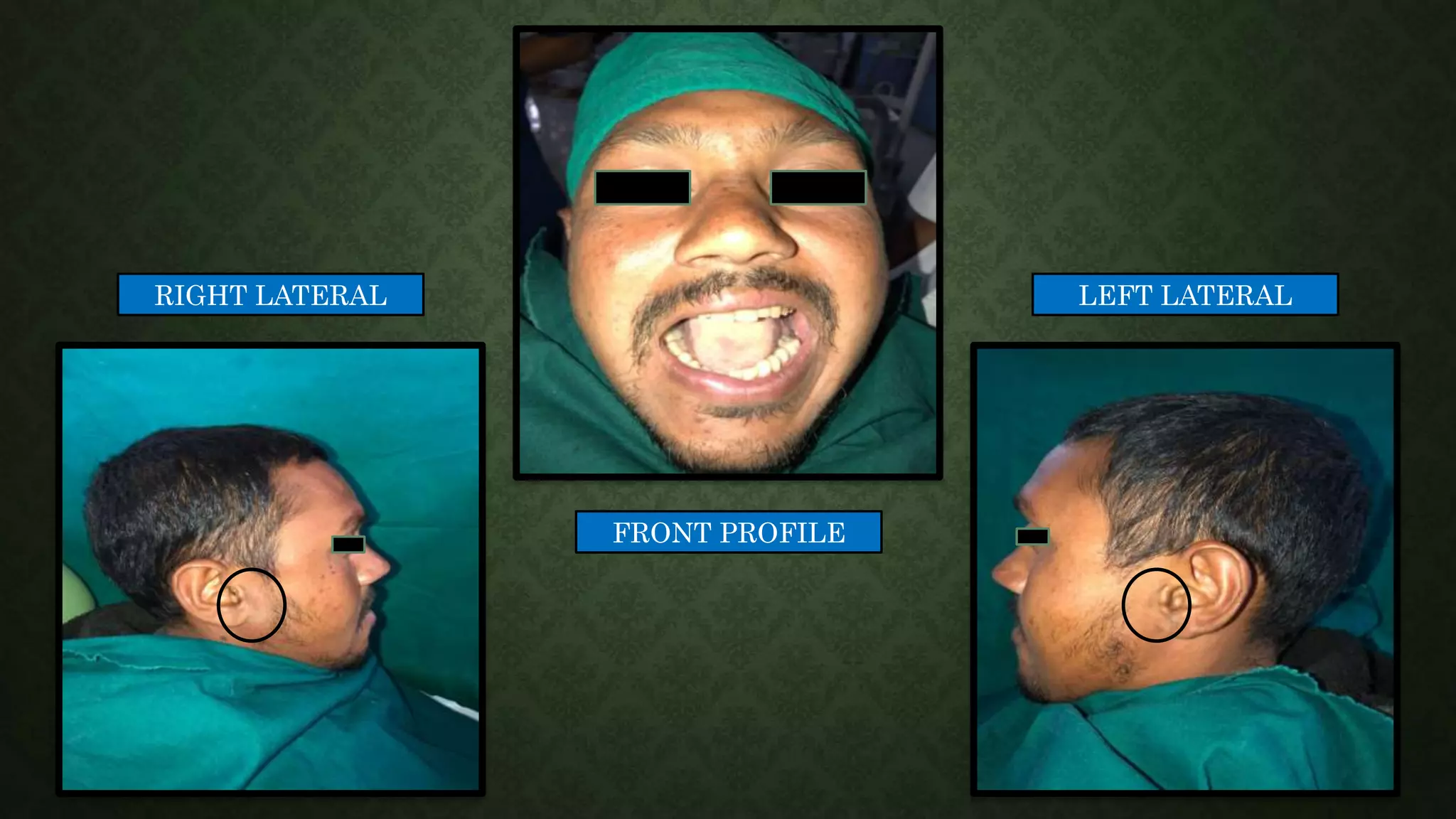 Case of bilateral tmj dislocation | PPTX
