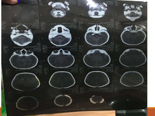 Case of birth asphyxia | PPTX