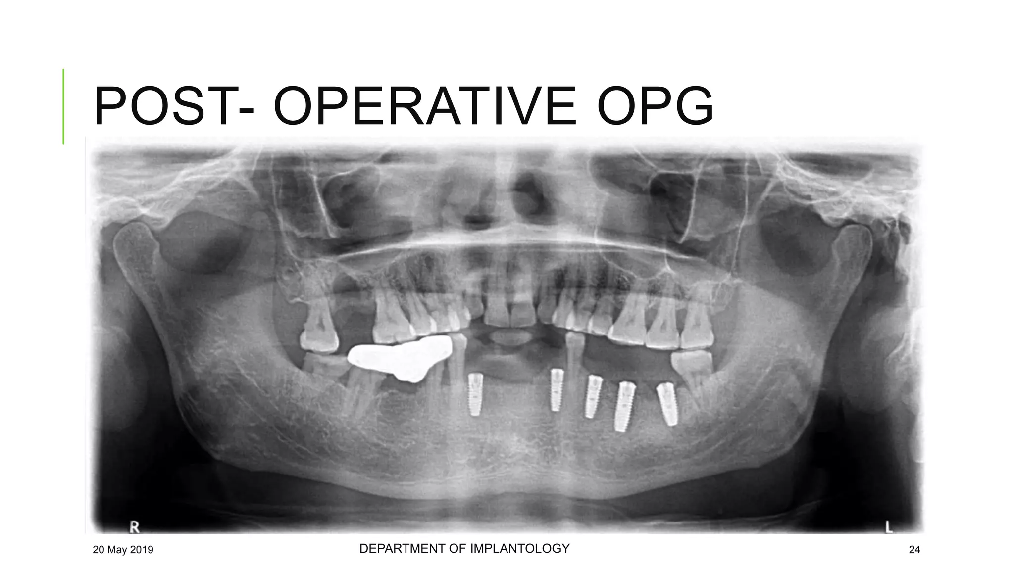 Case of immediate implant placement using bone ring technique | PPTX ...