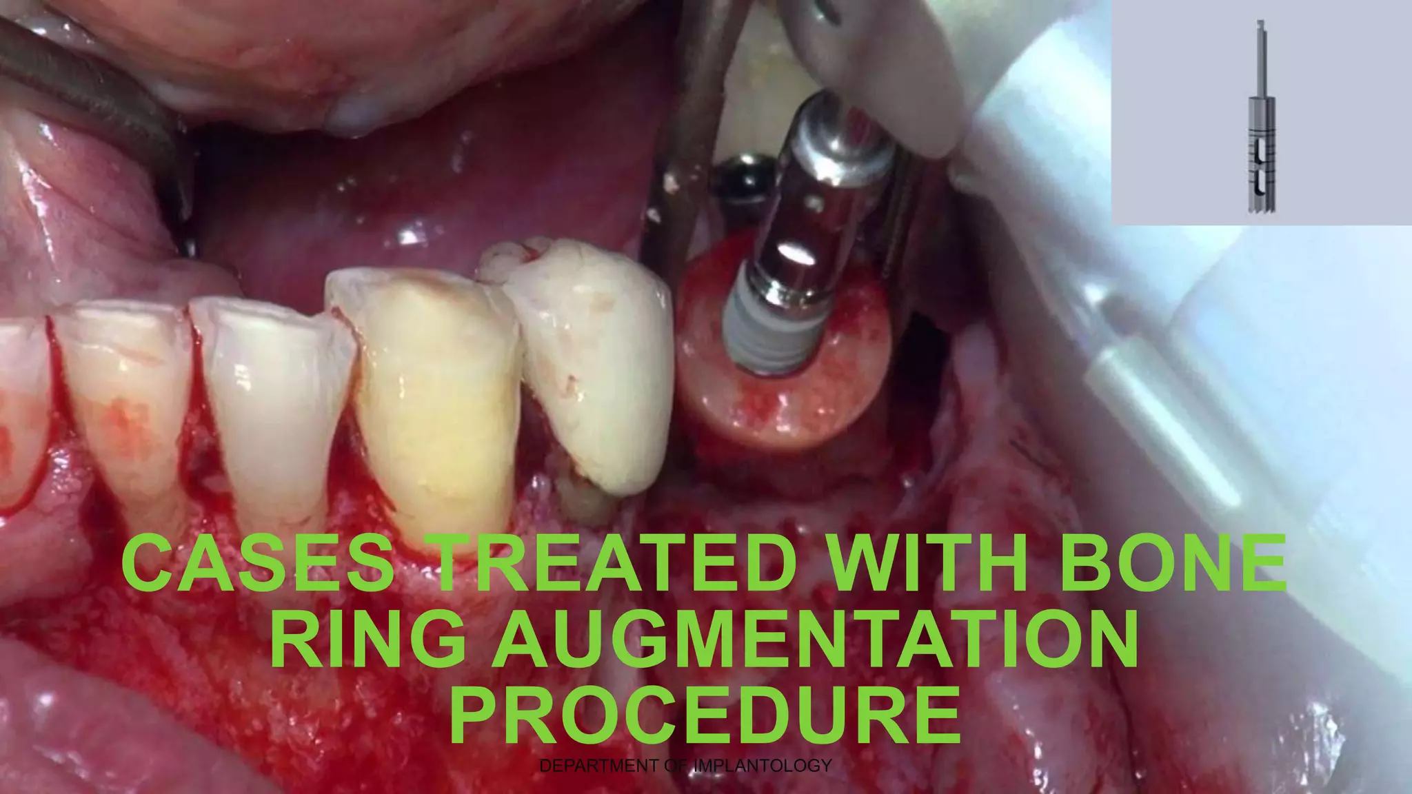 Case of immediate implant placement using bone ring technique | PPTX