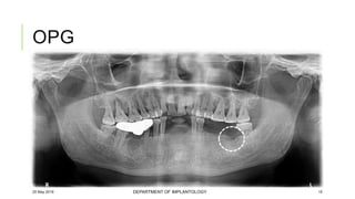 Case of immediate implant placement using bone ring technique | PPTX