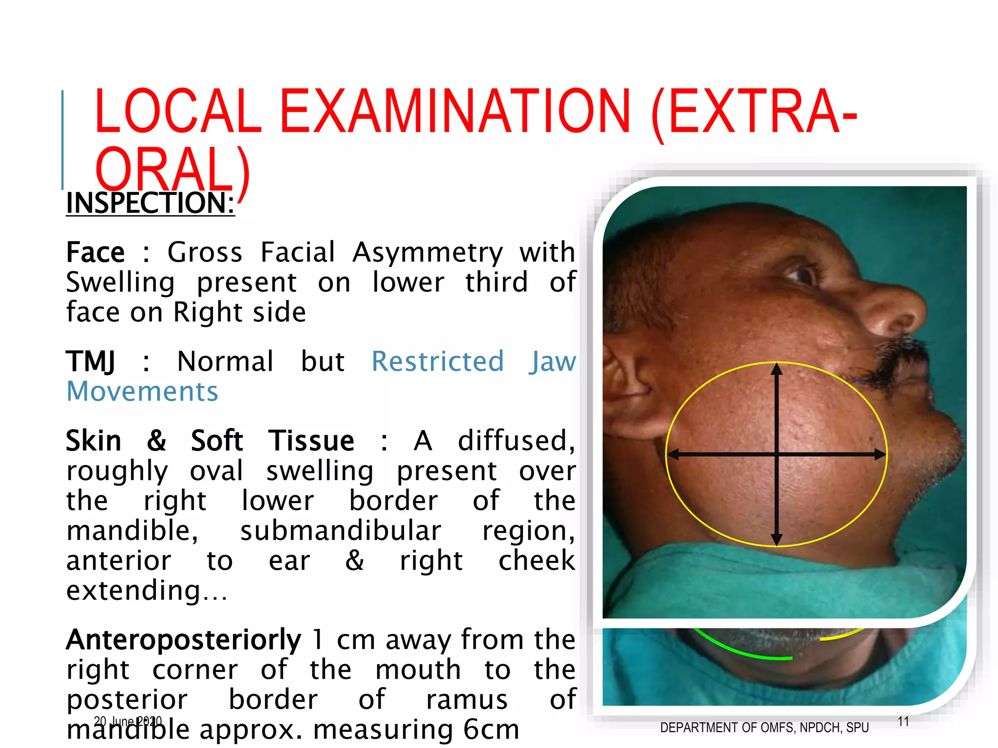 Case of epidermoid cyst in mandible a rare entity and review. | PPTX