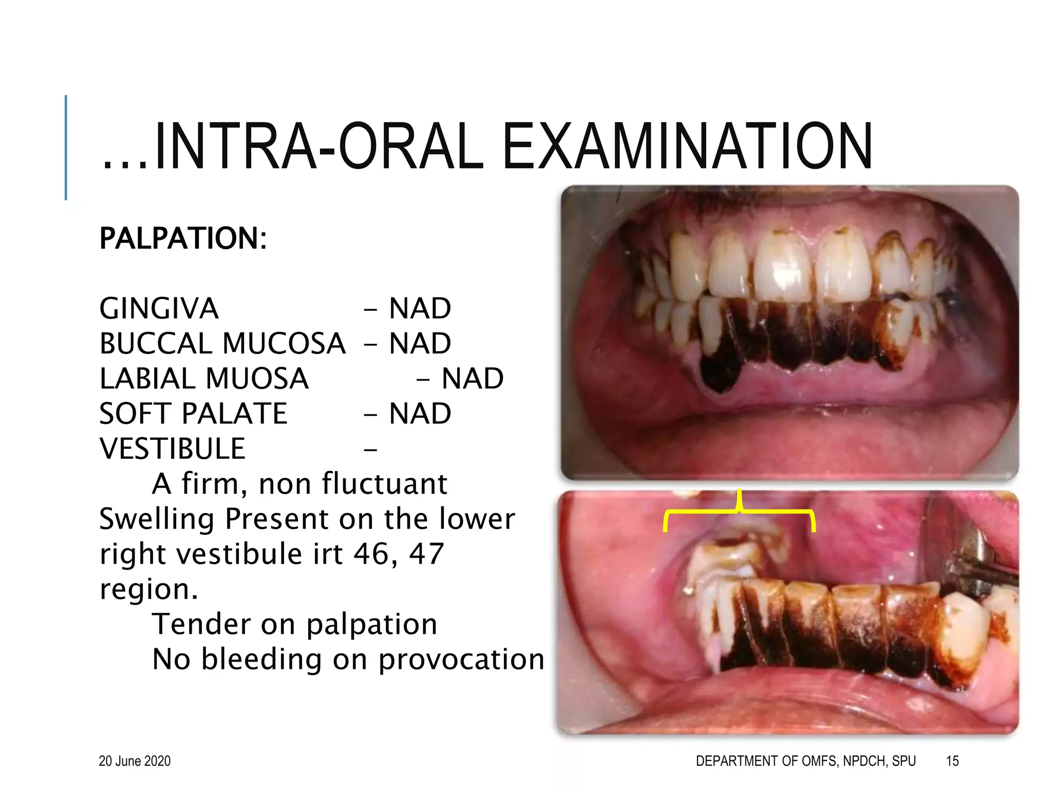 Case of epidermoid cyst in mandible a rare entity and review. | PPTX