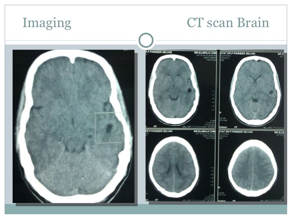 A Case of Neurocysticercosis