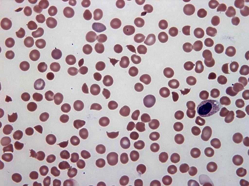 A Case of Atypical Hemolytic Uremic Syndrome