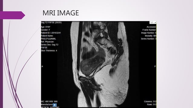 Case of mrkh with vaginal hypoplasia for vaginoplasty | PPTX | Pregnancy | Reproductive Health