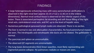 case of nephroblastome. very good onepptx | PPT