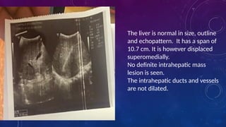 case of nephroblastome. very good onepptx | PPTX