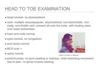 RASH, ARTHRITIS,LUPUS NEPHRITIS | PPTX