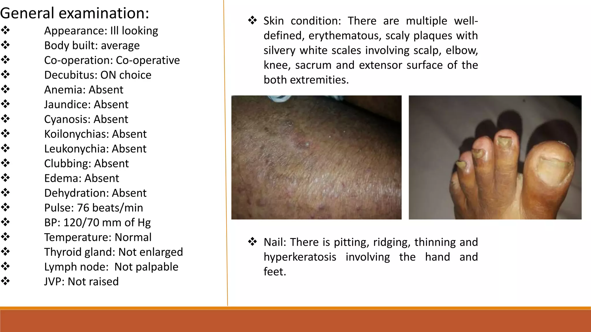 Case of psoriatic arthritis | PPTX