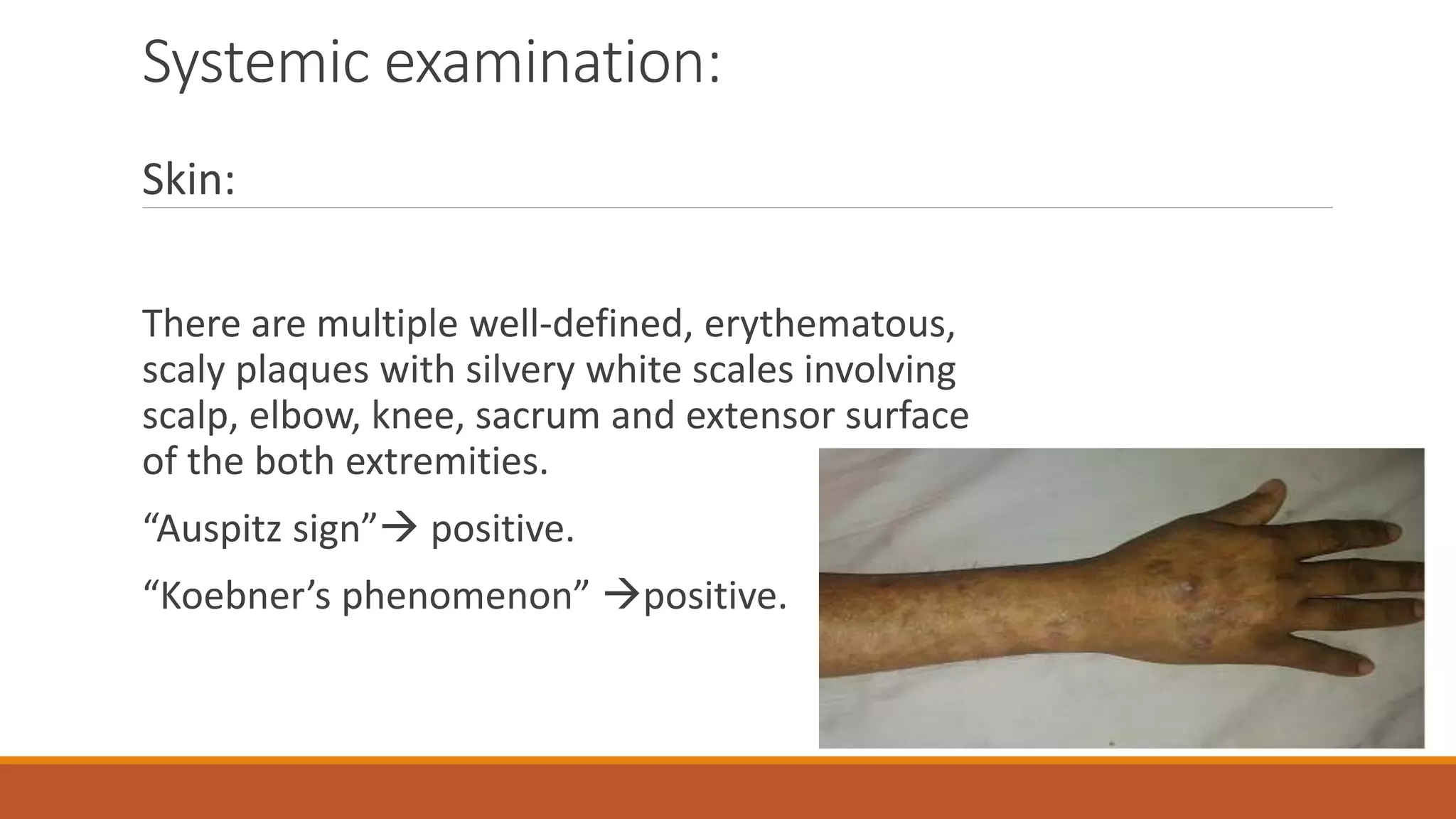 Case of psoriatic arthritis | PPTX