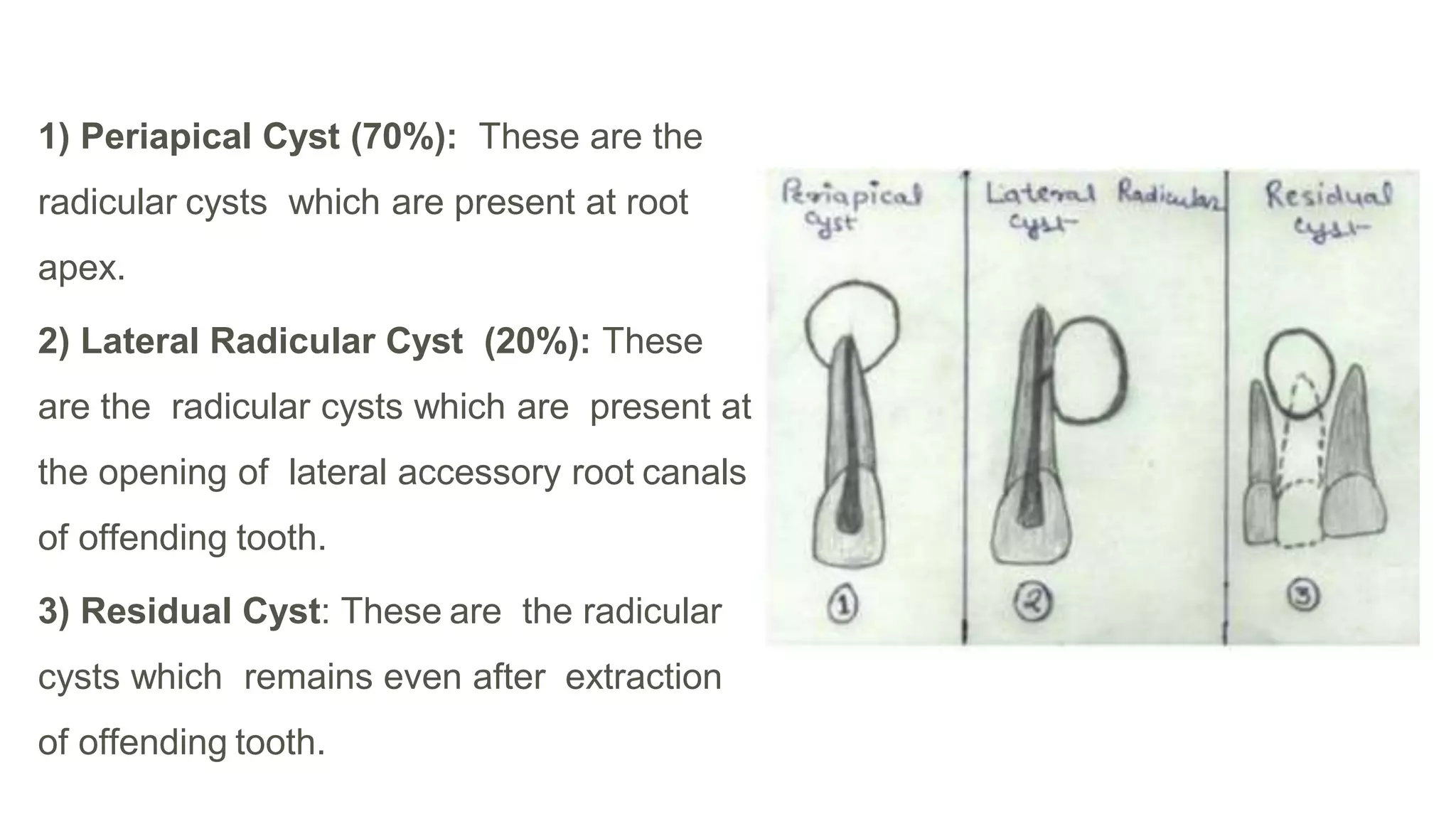 Case of Radicular Cyst | PPTX