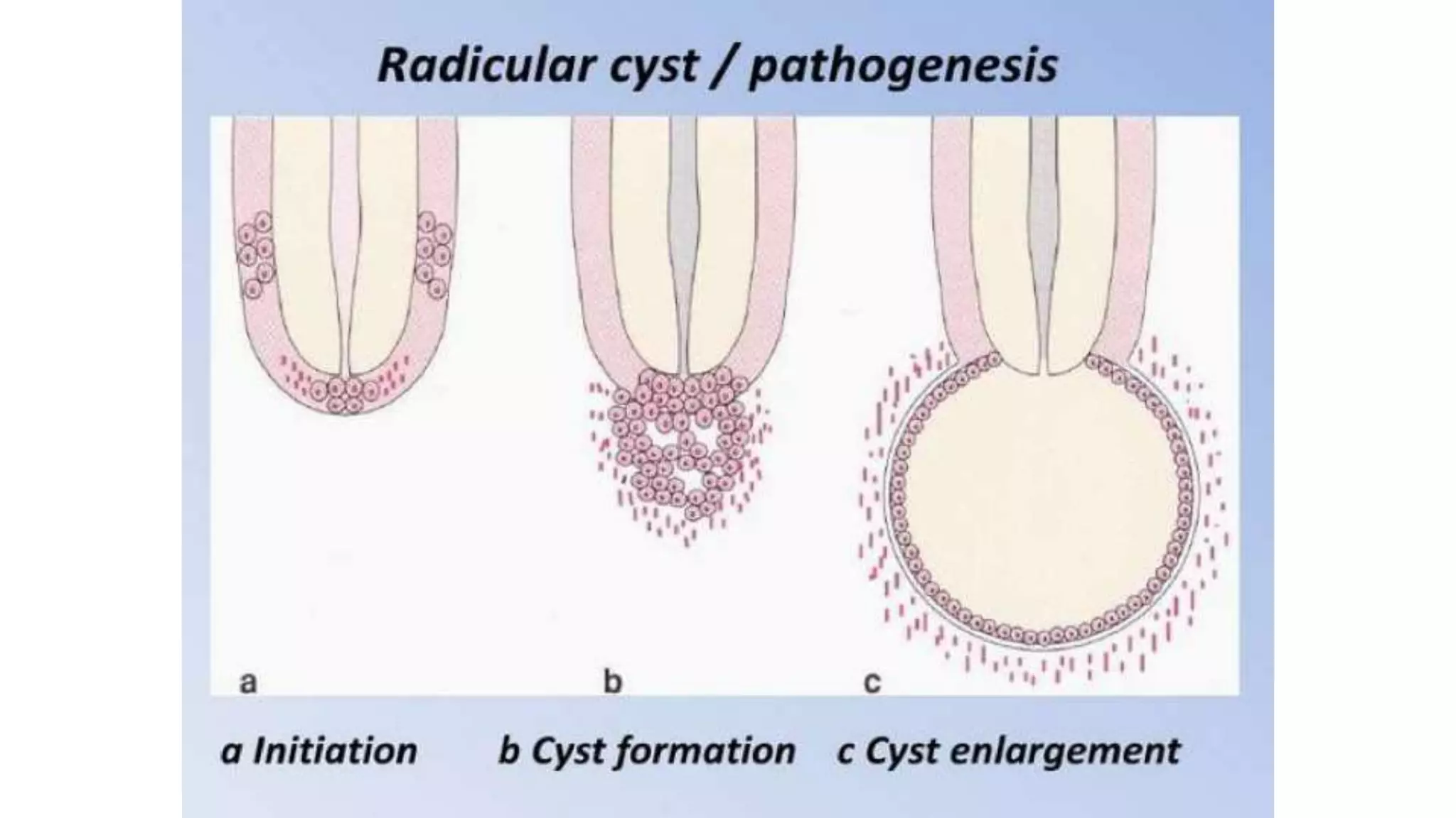 Case of Radicular Cyst | PPTX