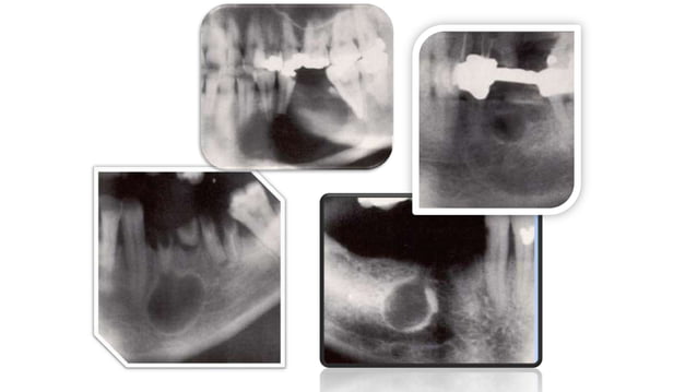 Case of Radicular Cyst | PPTX