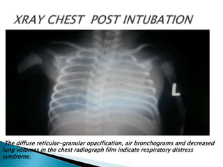 Case of rds | PPTX | Pregnancy | Reproductive Health