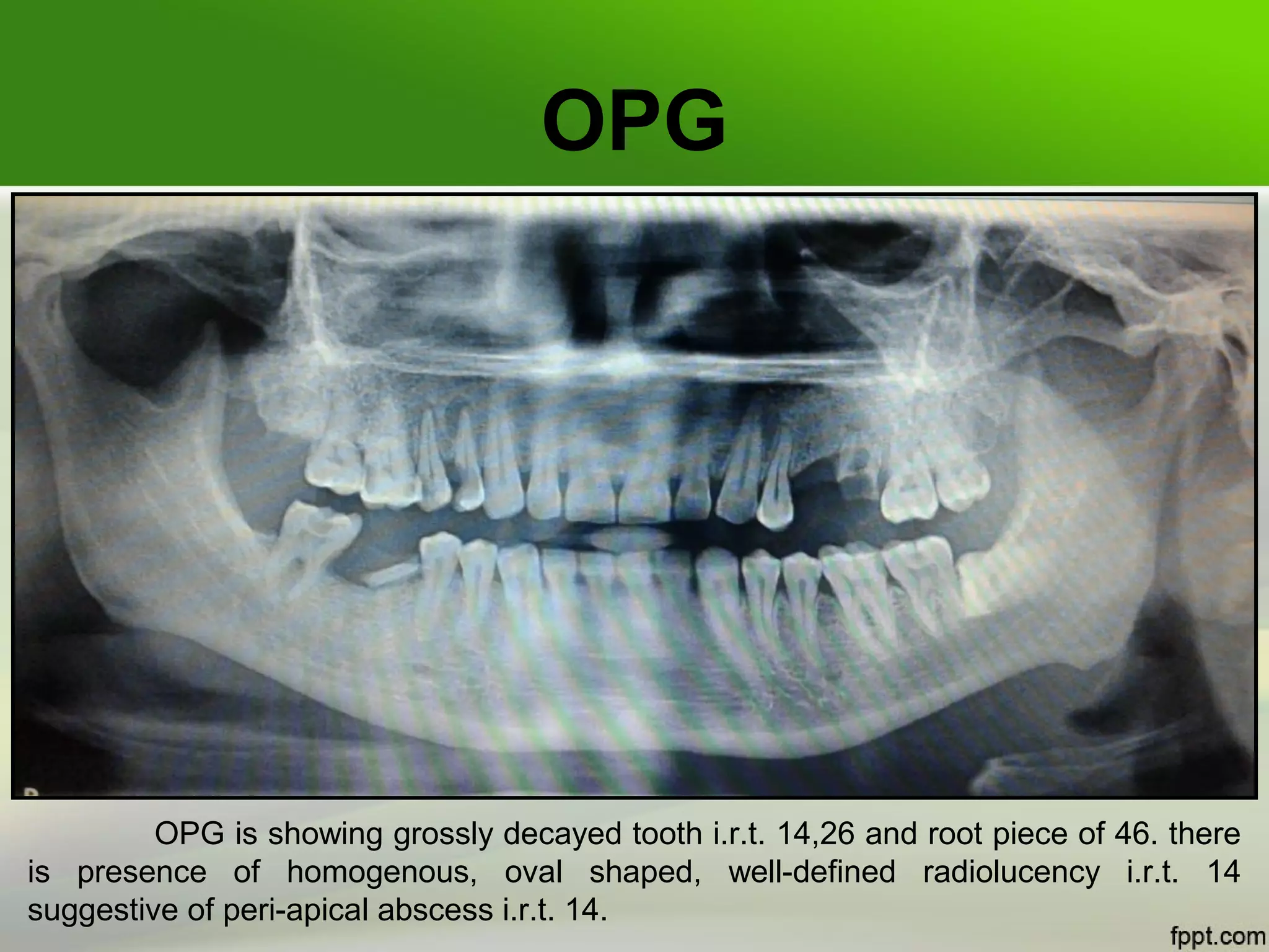 Case of space infection | PPT