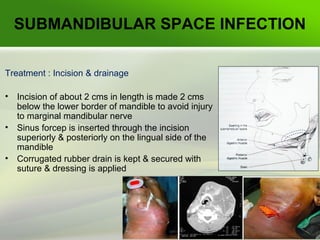 Submandibular Space