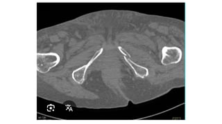 Case of the week RTA patient with multiple fracture | PPTX