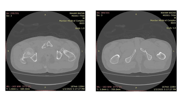 Case of the week RTA patient with multiple fracture | PPTX