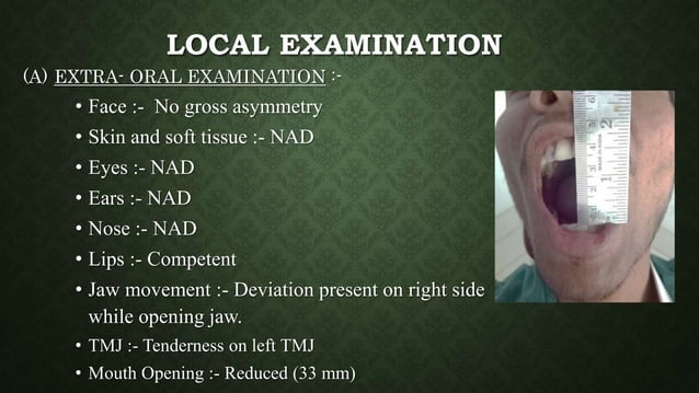 Case of TMJ Subluxation | PPTX