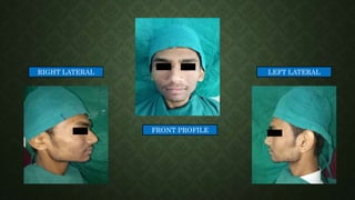 Case of TMJ Subluxation | PPTX