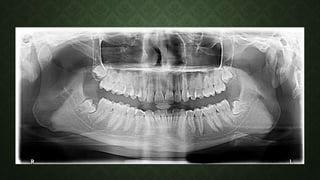 Case of TMJ Subluxation | PPTX