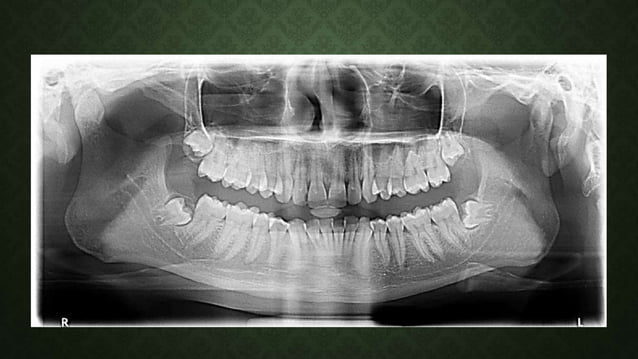 Case of TMJ Subluxation | PPTX