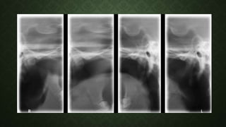 Case of TMJ Subluxation | PPTX