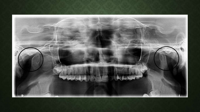 Case of TMJ Subluxation | PPTX