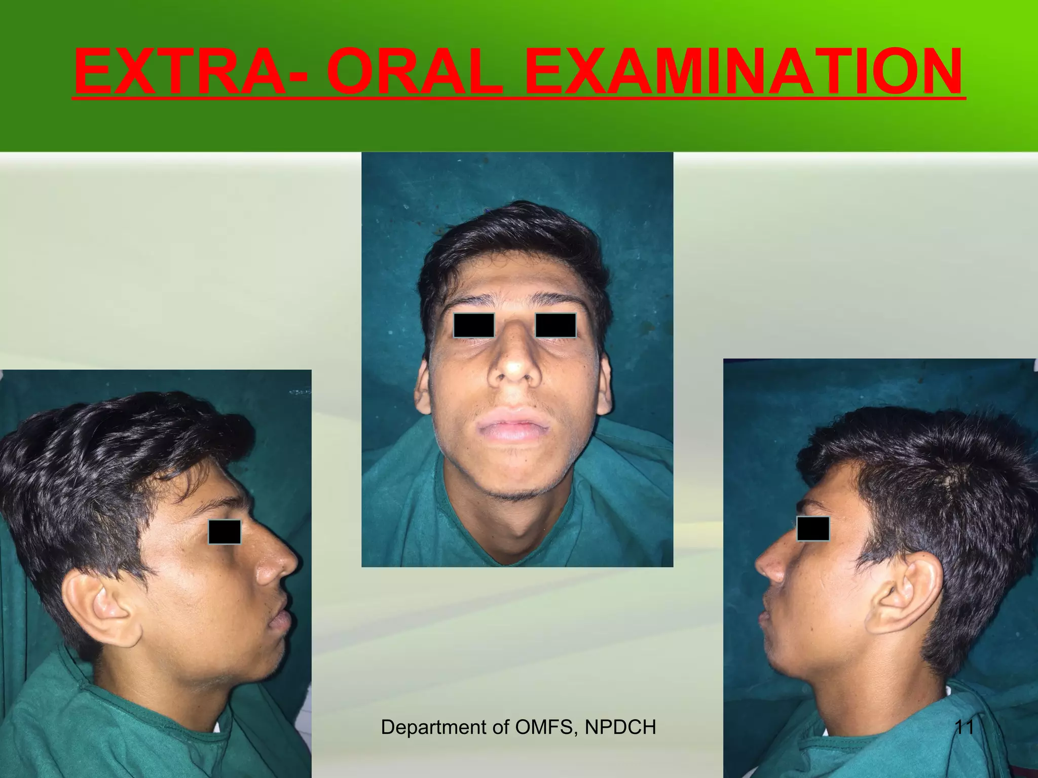 Case of trauma(Mandibular Left Parasymphysis and Right Angle Fracture ...