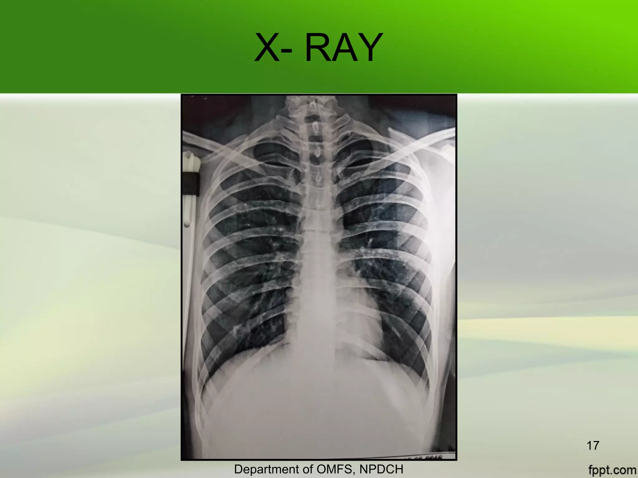 Case of trauma(Mandibular Left Parasymphysis and Right Angle Fracture ...