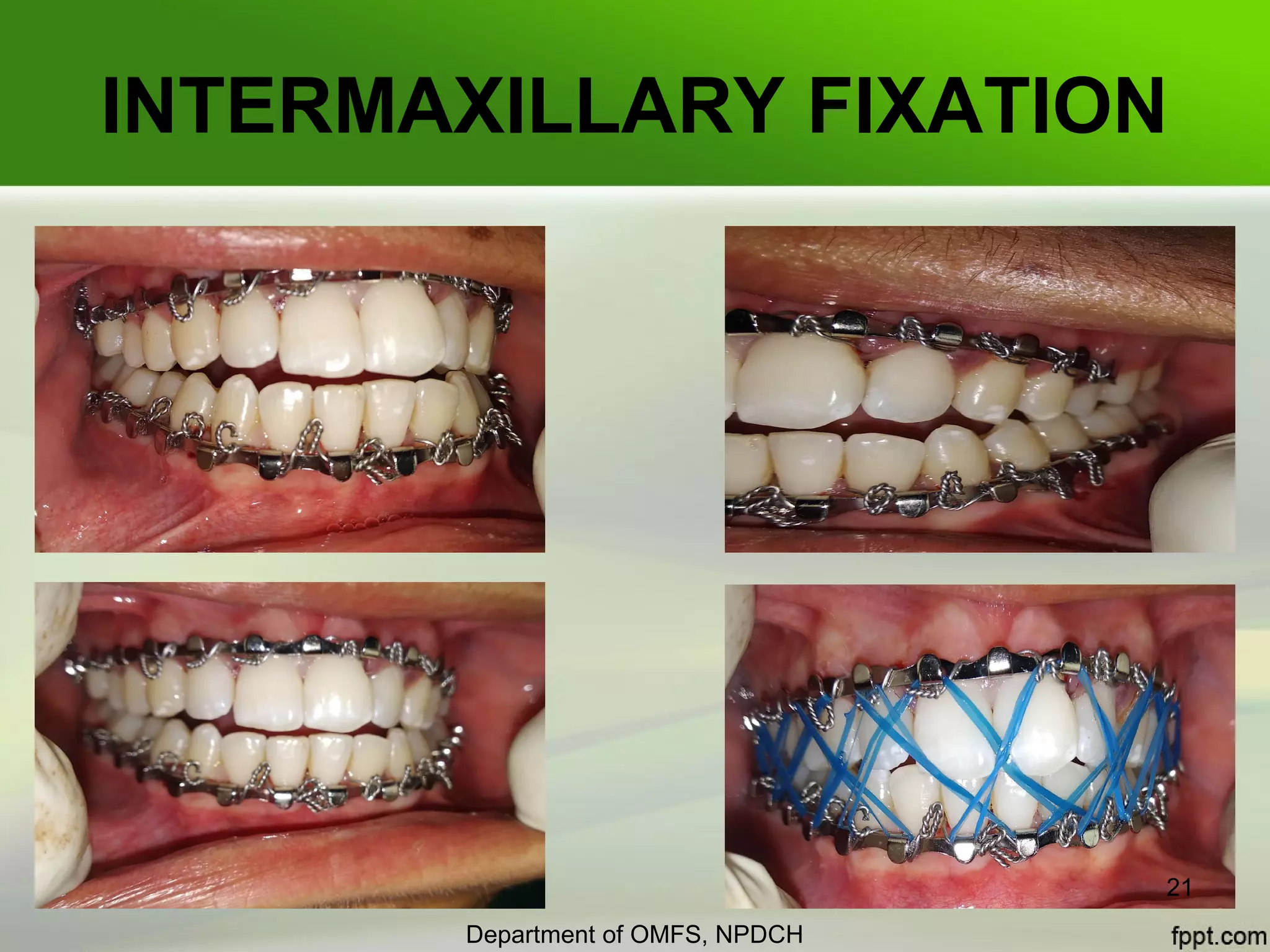 Case of trauma(Mandibular Left Parasymphysis and Right Angle Fracture ...