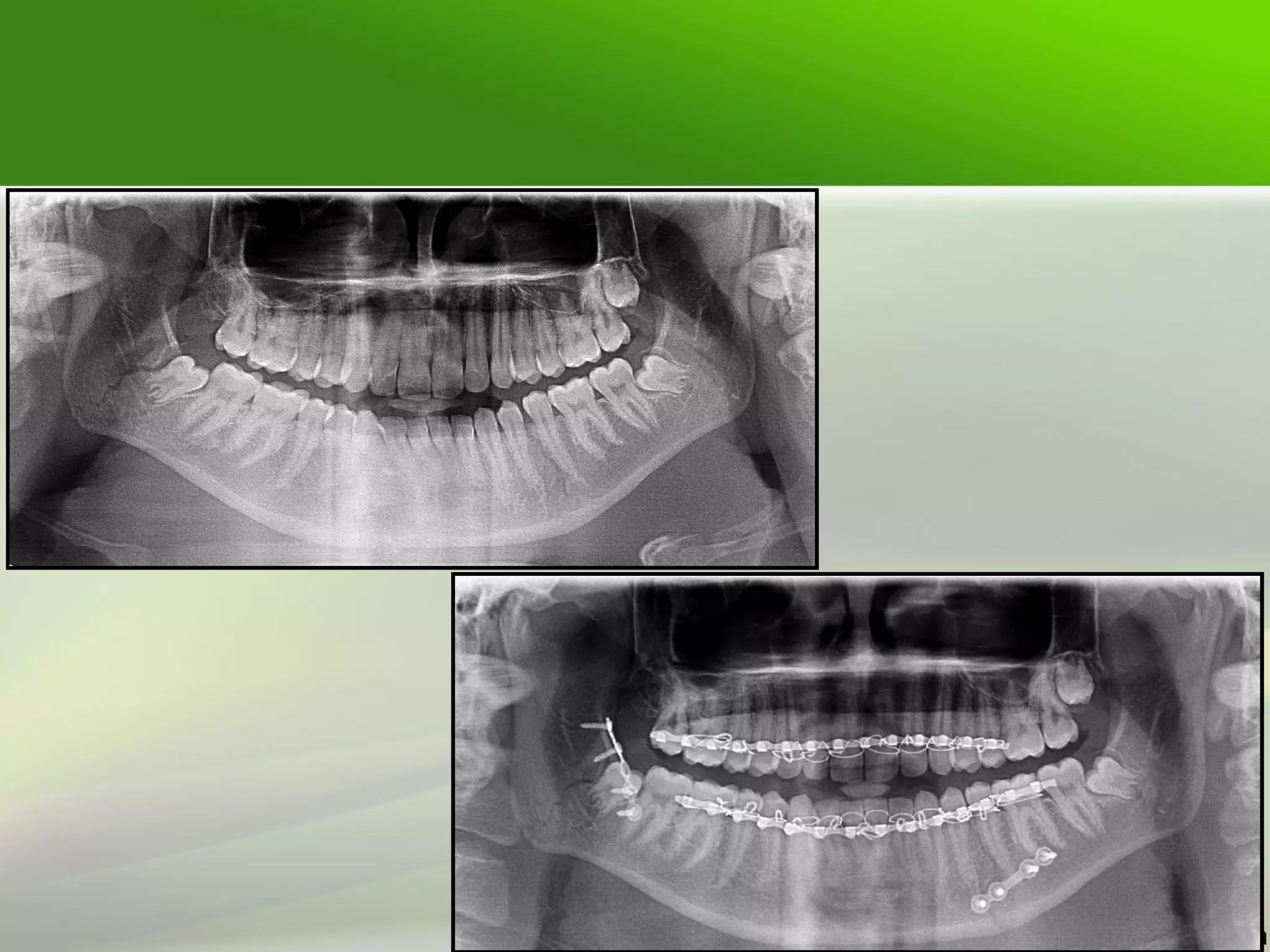 Case of trauma(Mandibular Left Parasymphysis and Right Angle Fracture ...
