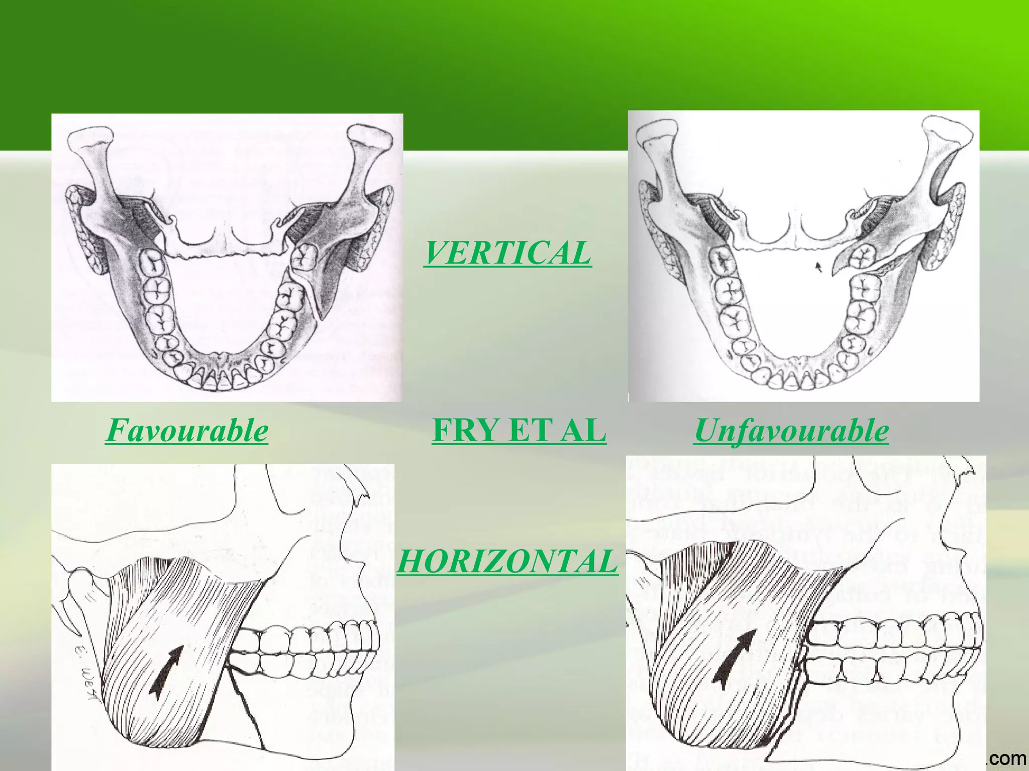 Case of trauma(Mandibular Left Parasymphysis and Right Angle Fracture ...