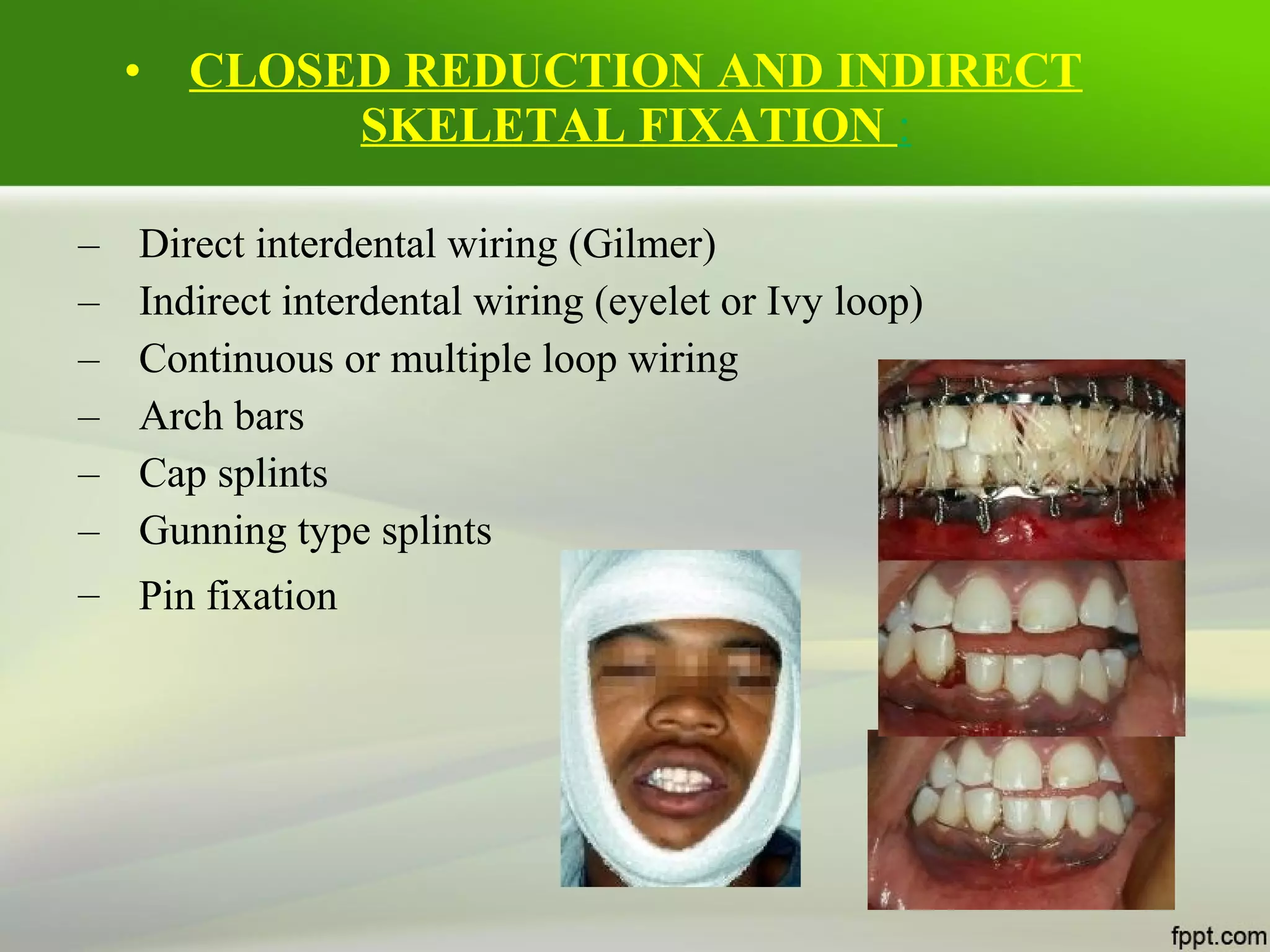 Case of trauma(Mandibular Left Parasymphysis and Right Angle Fracture ...