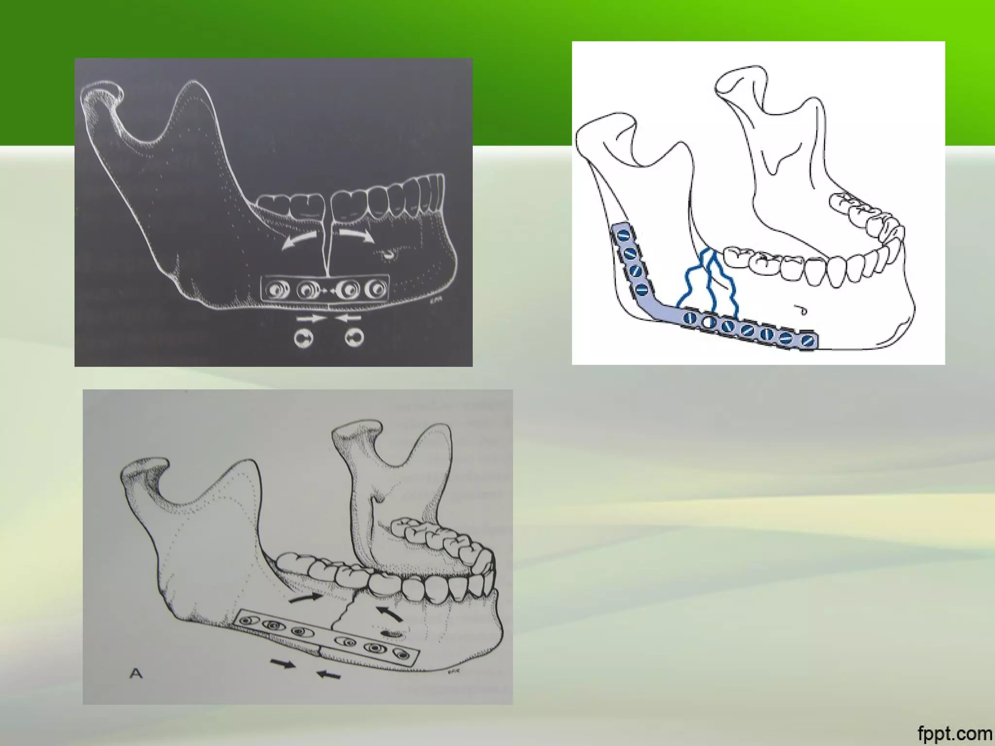 Case of trauma(Mandibular Left Parasymphysis and Right Angle Fracture ...
