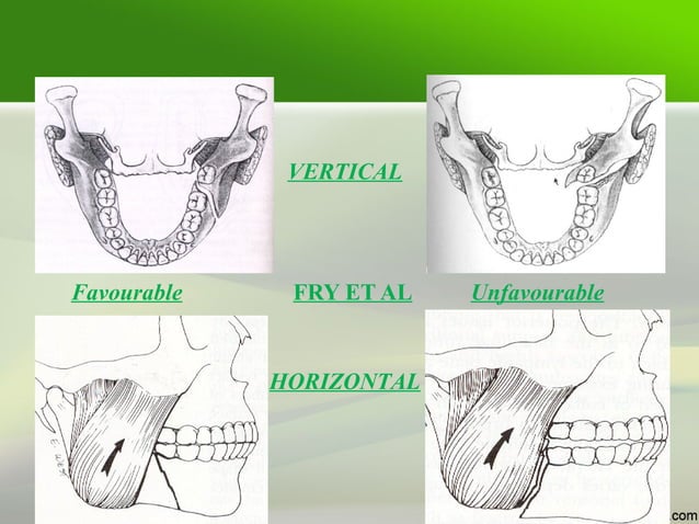 Case of trauma(Mandibular Left Parasymphysis and Right Angle Fracture ...